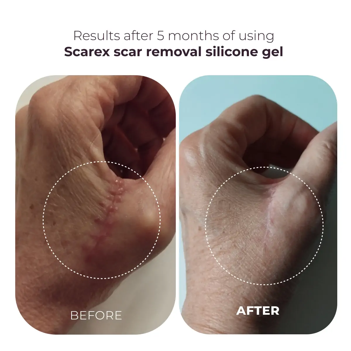 Scarex Scar Removal Silicone Gel - biotrade